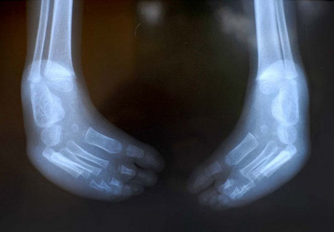 How the Ponseti Method caught on | Iowa Now - The University of Iowa